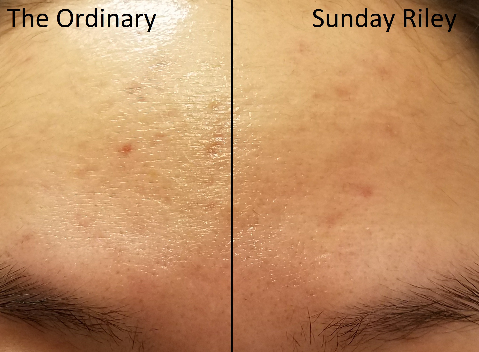 Sunday Riley “Good Genes” on Acne Scars & Fine Lines. Before AND Afters ...